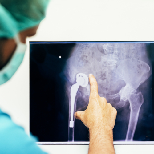 Hip Dislocation - Colorado Center of Orthopaedic Excellence